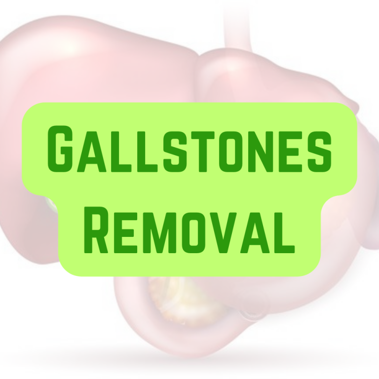 Gallstones removal instructions